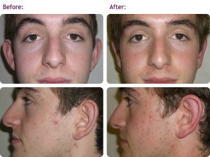 Prominent Ear Correction (Otoplasty) | Cosmetic Surgery Birmingham