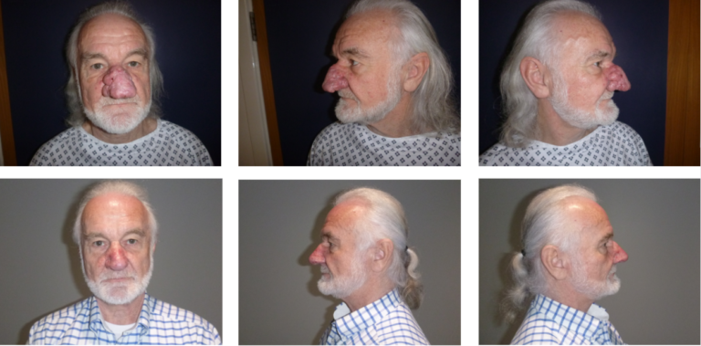 Rhinophyma Treatment | Cosmetic Surgery Birmingham